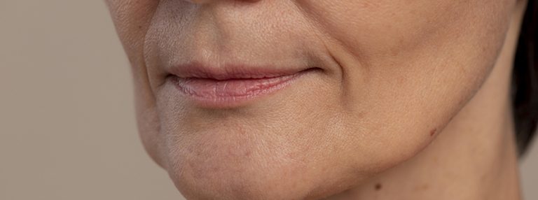 Bigode chinês: causas e tratamentos | Pró-Corpo Estética Avançada