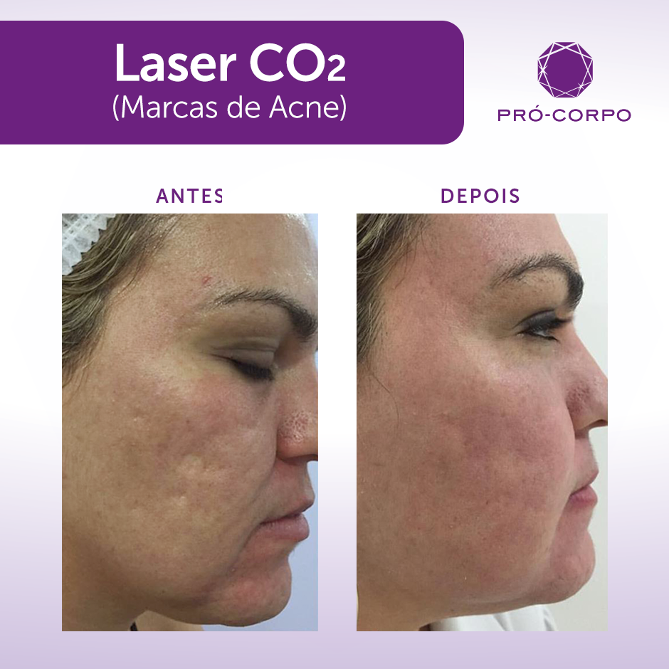 Marcas de Acne: Causas e Tratamentos Estéticos | Pró-Corpo