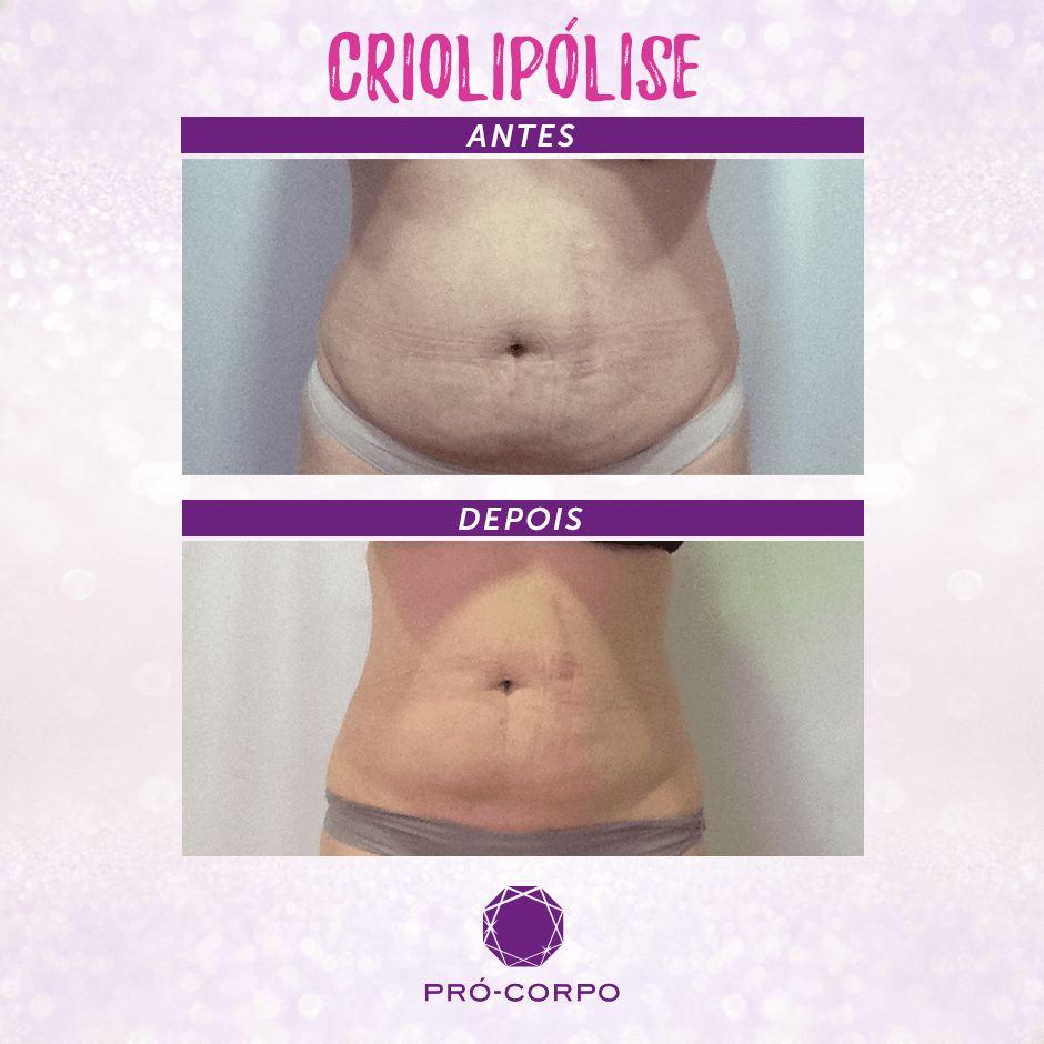 Criolipólise: Tratamento estético para gordura localizada | Pró-Corpo