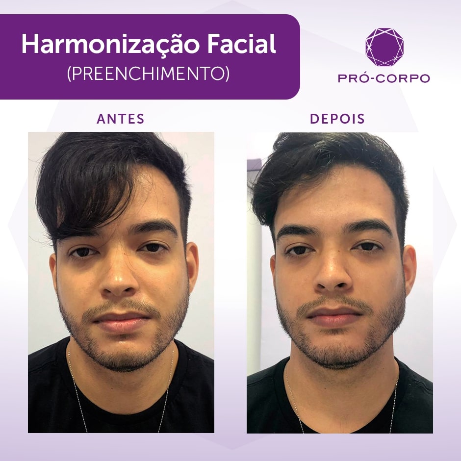 Harmonização Facial: Harmoniza e rejuvenesce o seu rosto | Pró-Corpo
