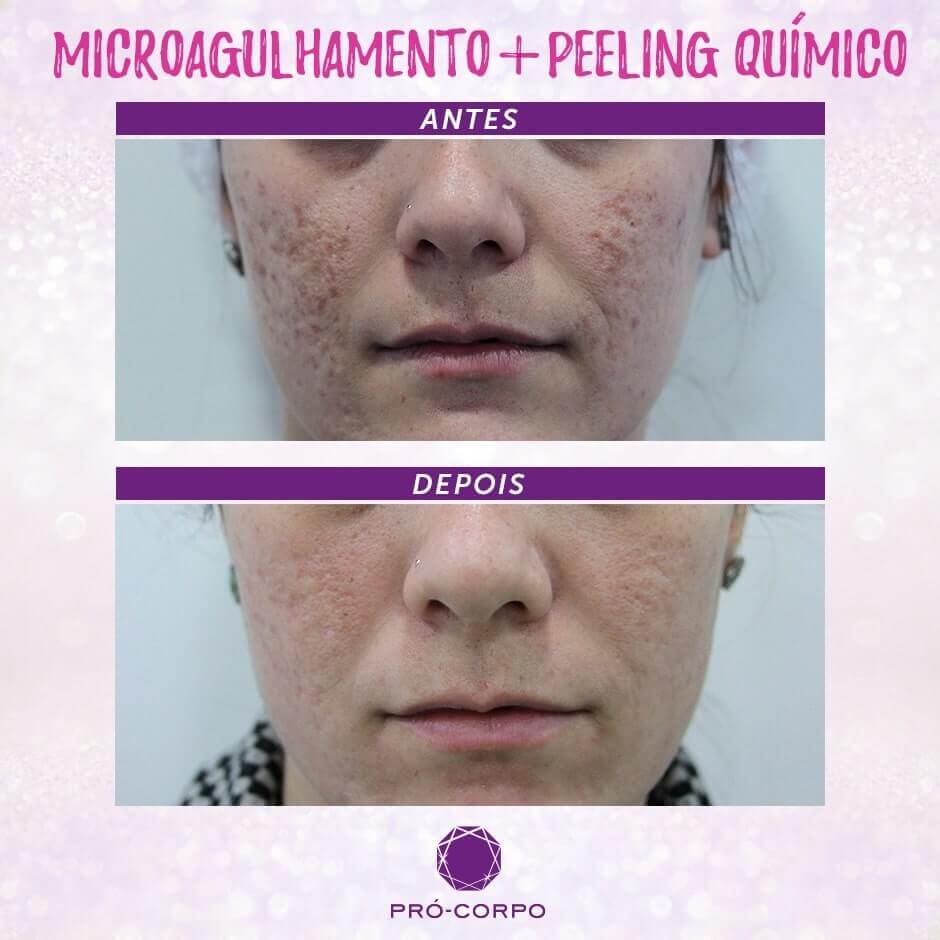 Microagulhamento: Combate cicatrizes e estrias | Pró-Corpo