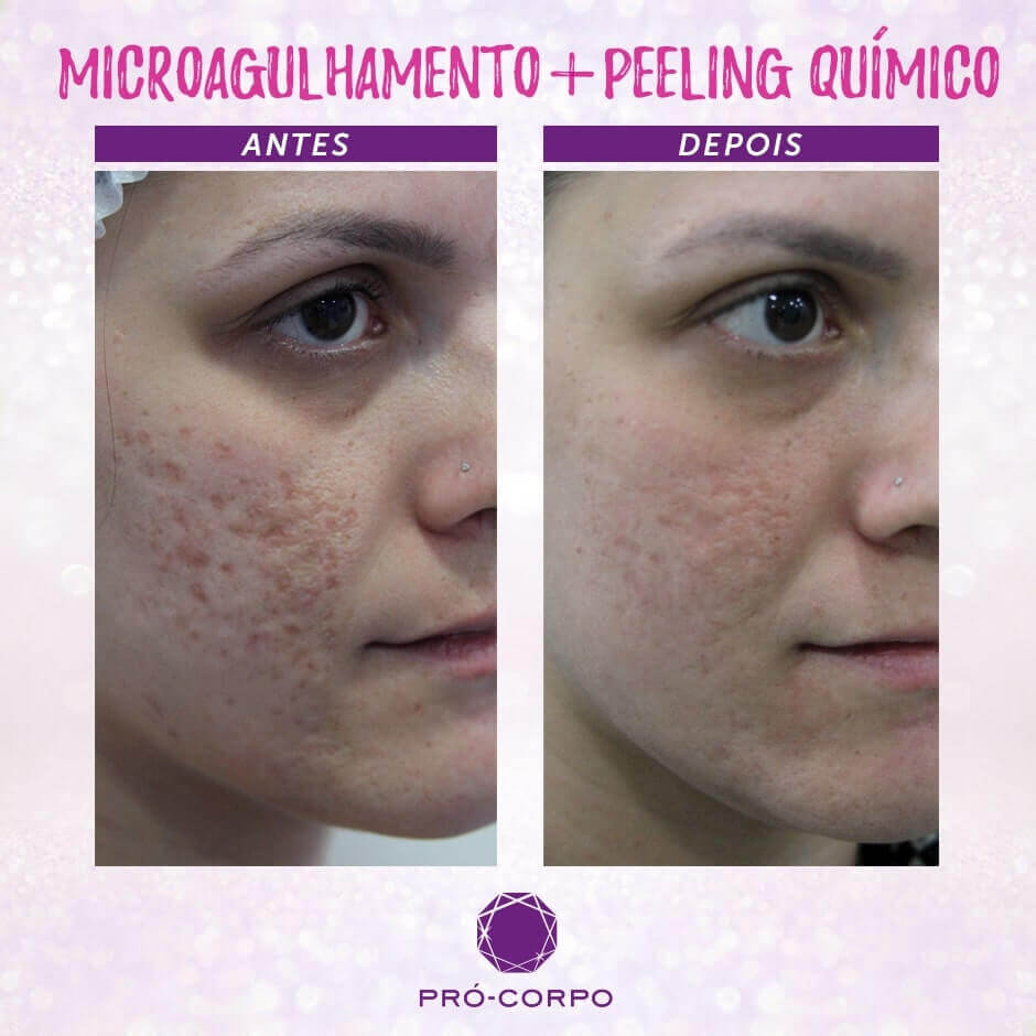 Remocao De Cicatrizes De Acne