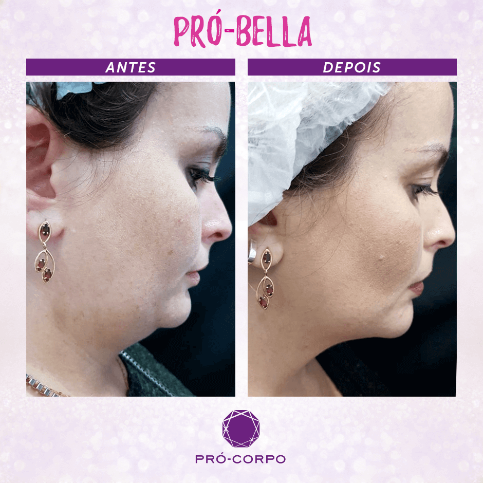 Cirurgia De Papada Antes E Depois - Cultura Notícias