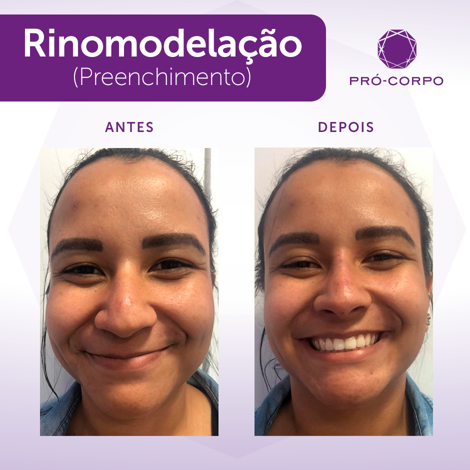 Rinomodelação: Procedimento remodela o nariz sem cirurgia | Pró-Corpo