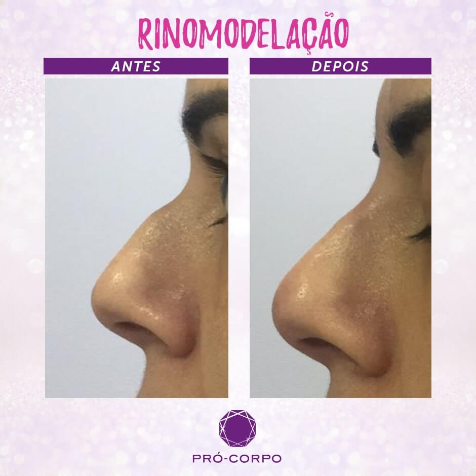Rinomodelação: Procedimento remodela o nariz sem cirurgia | Pró-Corpo