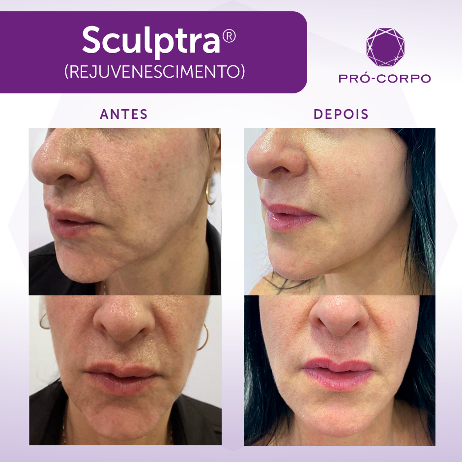 Sculptra®: Rejuvenescimento e combate à Flacidez| Pró-Corpo